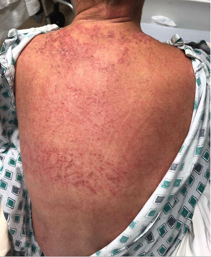 VANCOMYCIN-INDUCED DRESS SYNDROME: AN UNCOMMON REACTION TO A COMMON ...