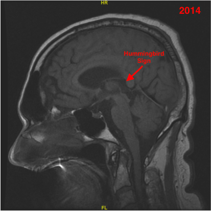 Hummingbird Sign Mri