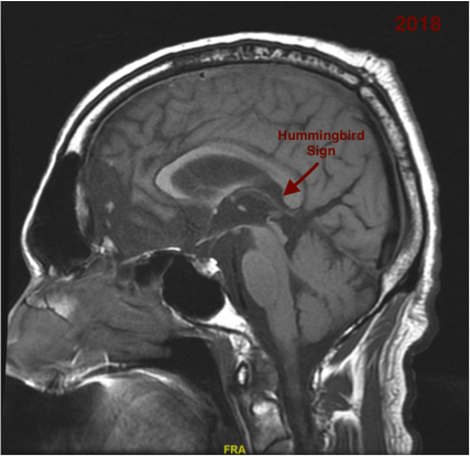 Hummingbird Sign Mri