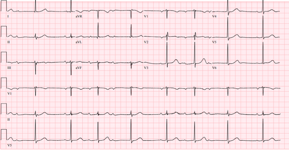 HIGH-DEGREE ATRIOVENTRICULAR BLOCK WITH SUPERIMPOSED SINOATRIAL NODE ...