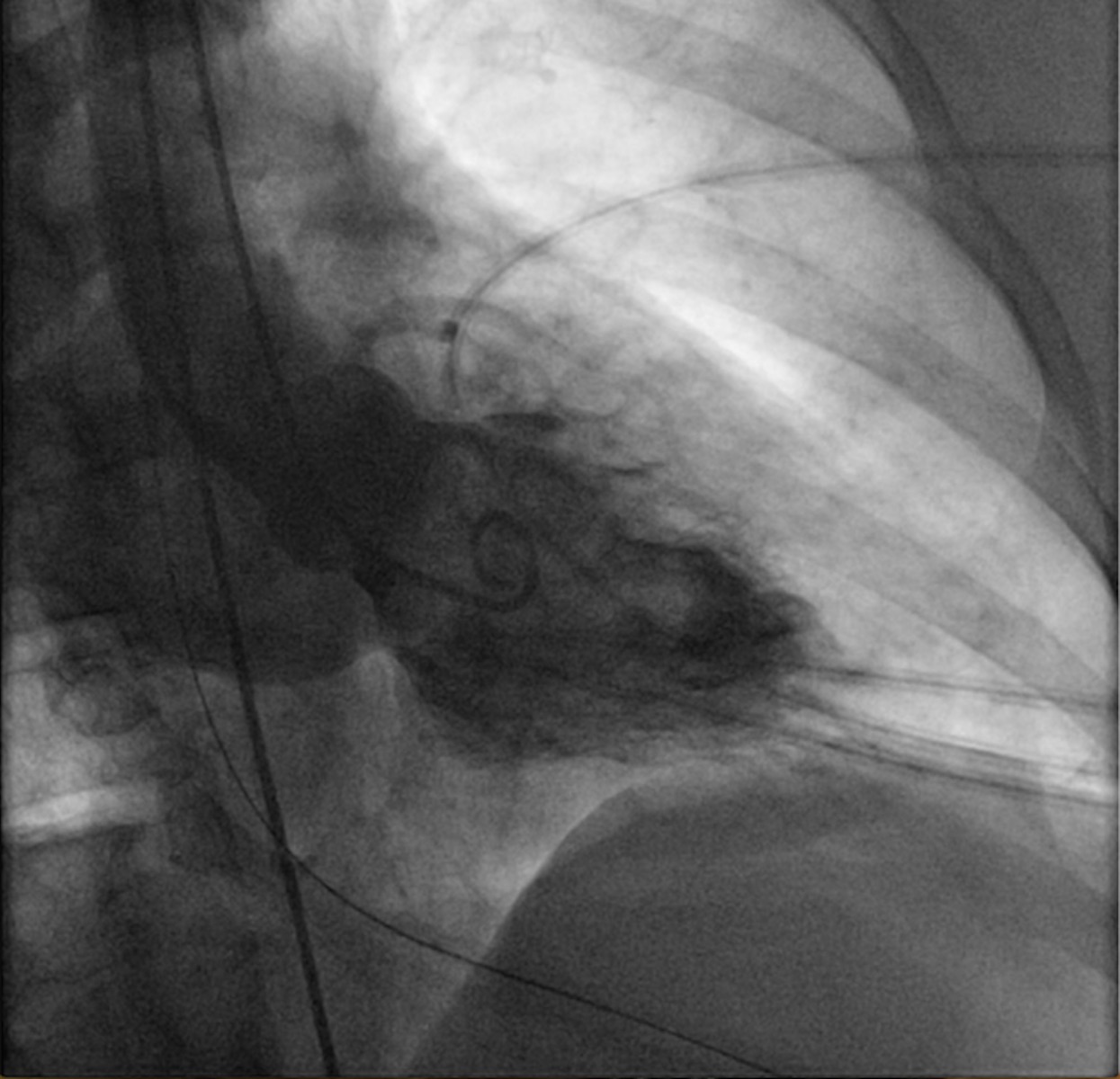 Acute Severe Mitral Regurgitation With Cardiogenic Shock Due To ...