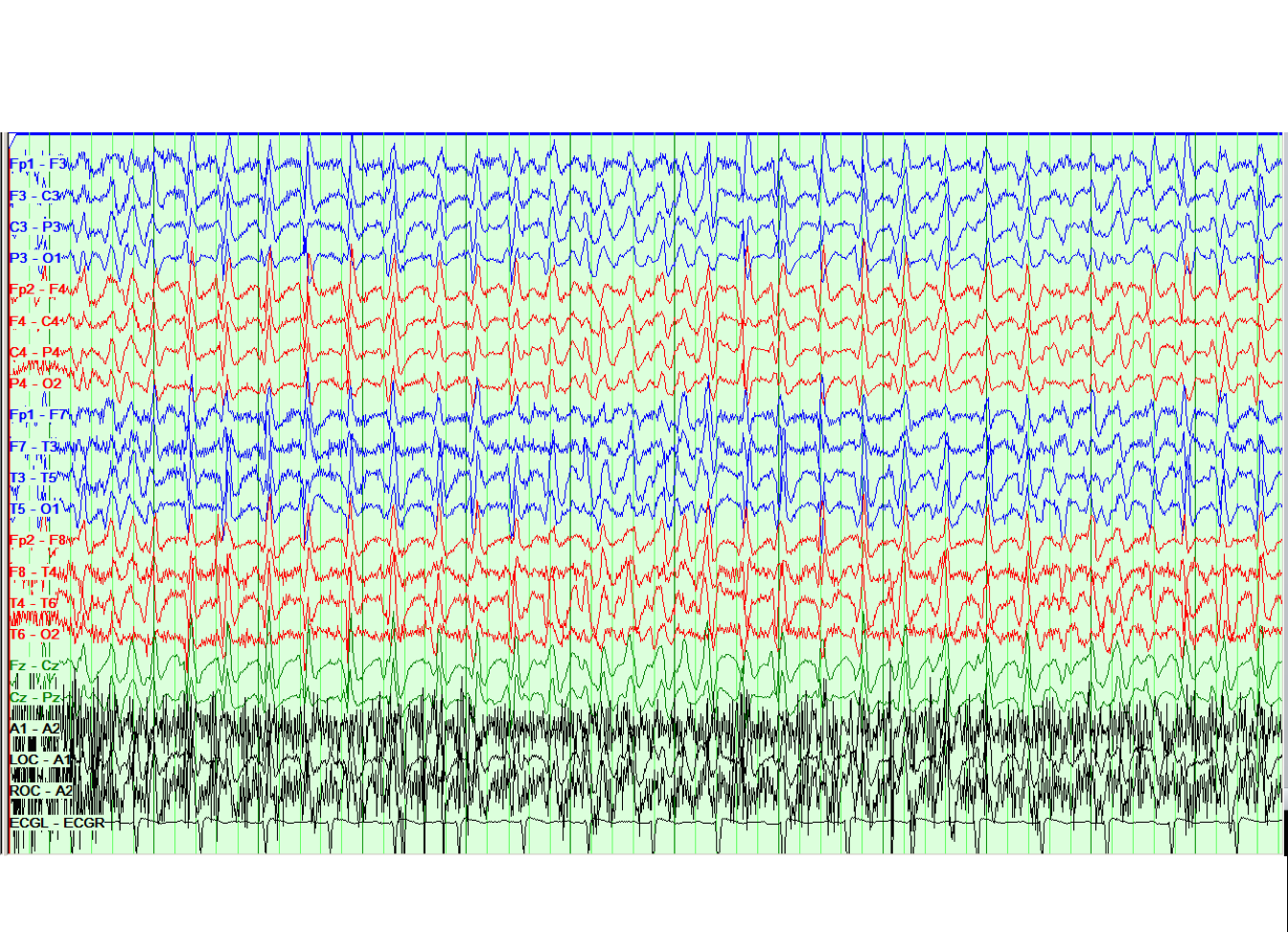 SEIZURE OR SIRPIDS A CASE OF ALTERED MENTAL STATUS SHM Abstracts